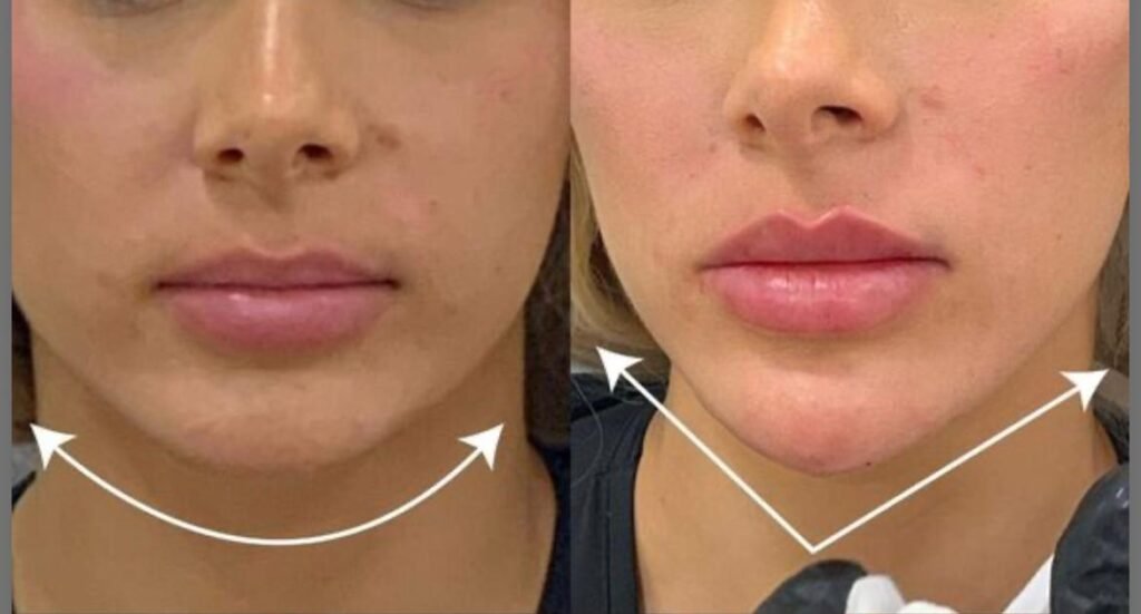 Fillers, Botox, and PRP for a Full Face Rejuvenation - Beiamed