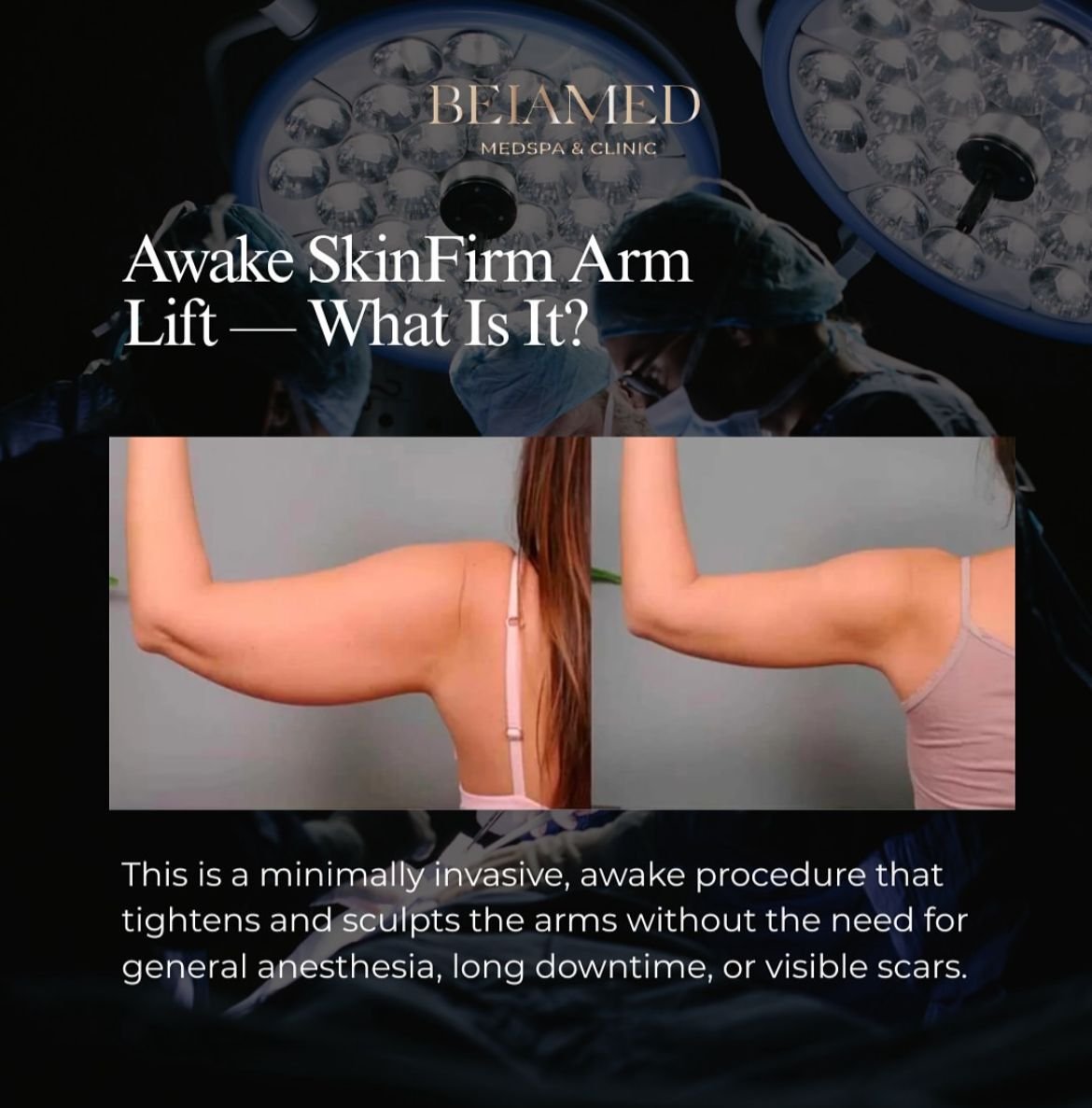 All You Need to Know About Awake SkinFirm Arm Lift - Beiamed